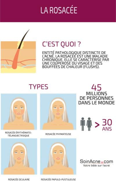 Rosacée - Causes, sous-types, traitements et personnes à risque